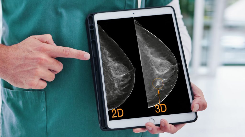 Mamografía 3D - Tomosíntesis: el T.A.C. para la mama, herramienta vital ...